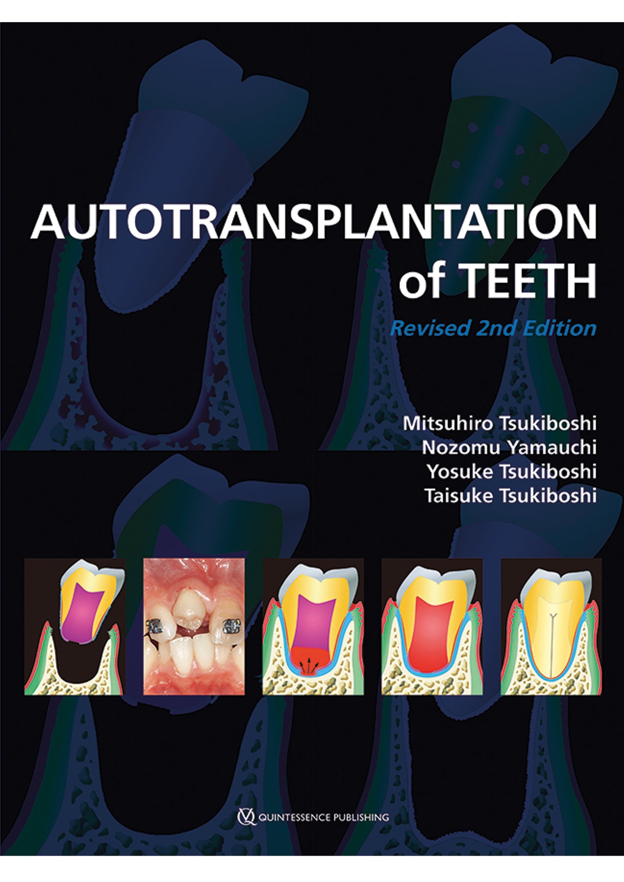 Autotransplantation of Teeth - Revised 2nd edition – Mi-tec Medical ...