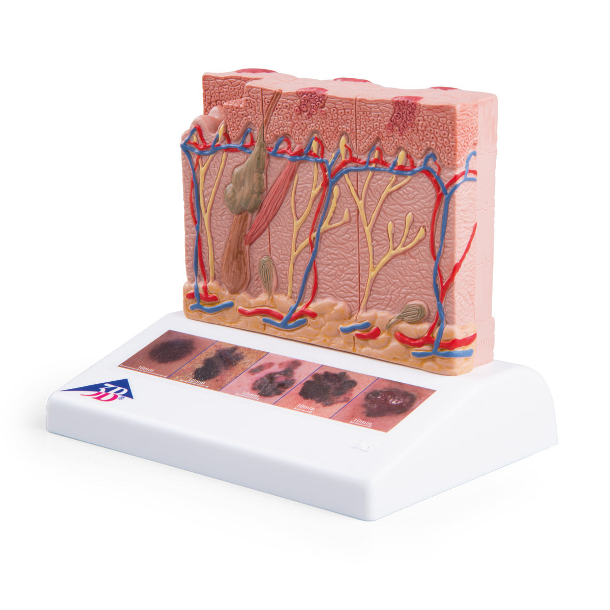 Skin Cancer Model – Mi-tec Medical Publishing
