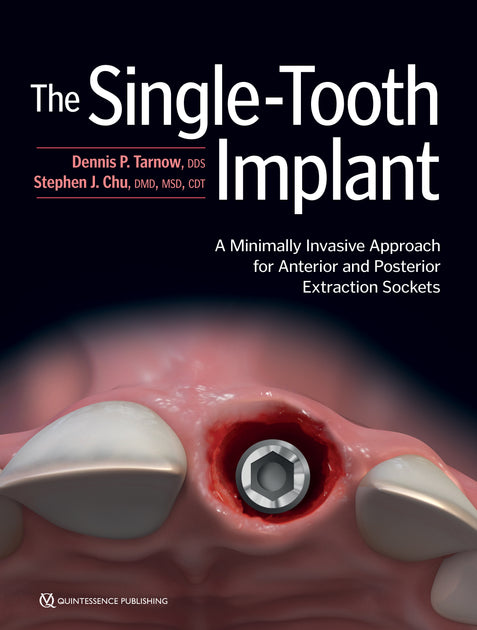 The Single-Tooth Implant: A Minimally Invasive Approach for Anterior a ...