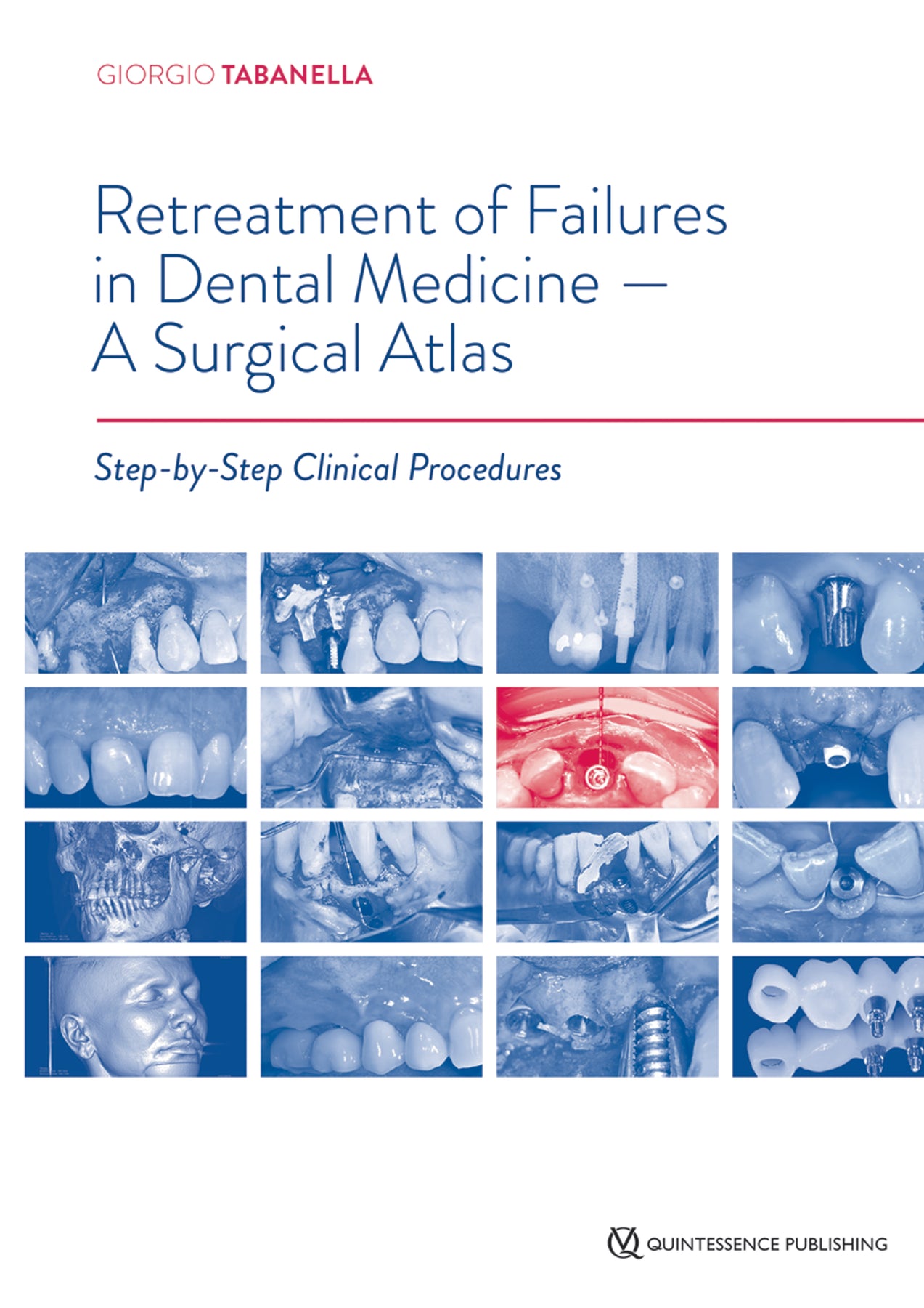 Retreatment of Failures in Dental Medicine – A Surgical Atlas: Step-by ...