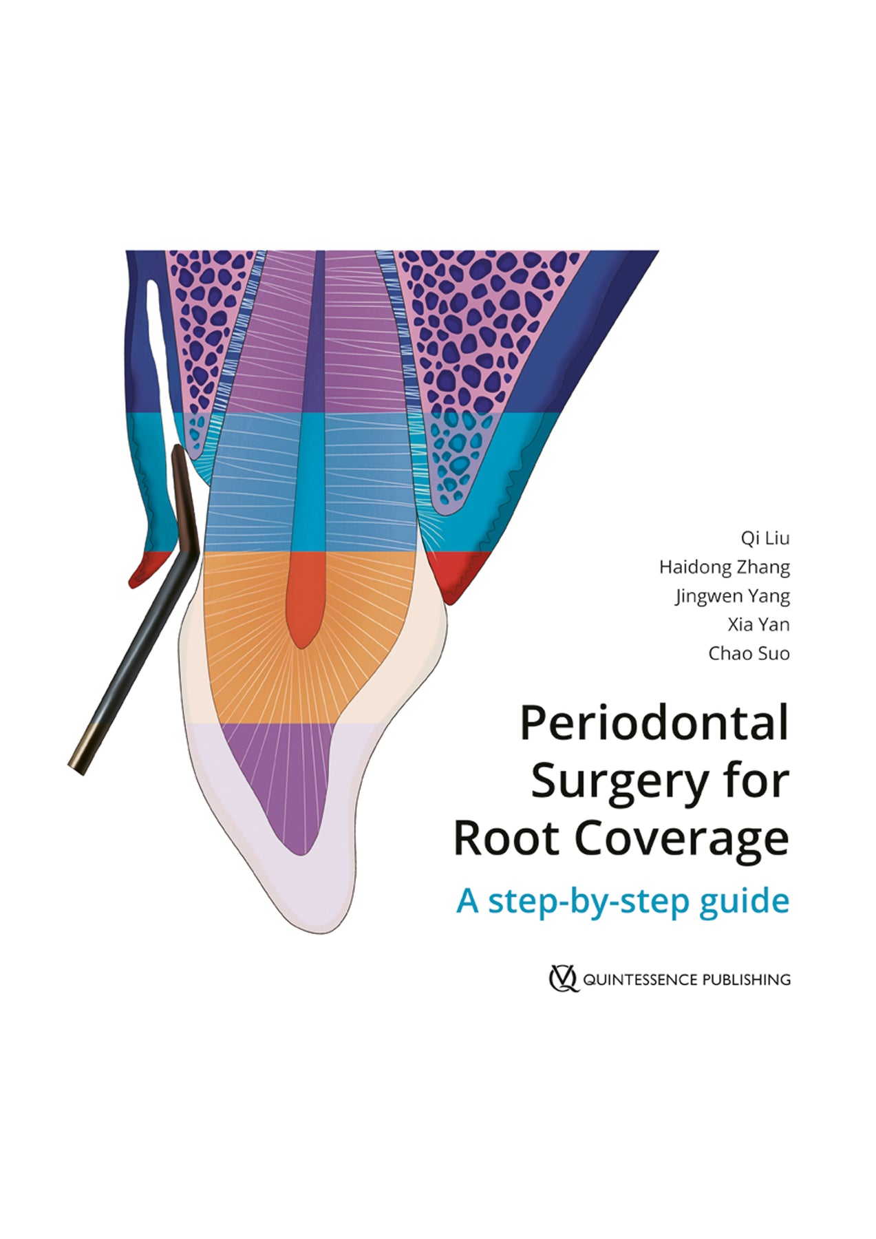 Periodontal Surgery for Root Coverage: A Step-by-Step Guide – Mi-tec ...