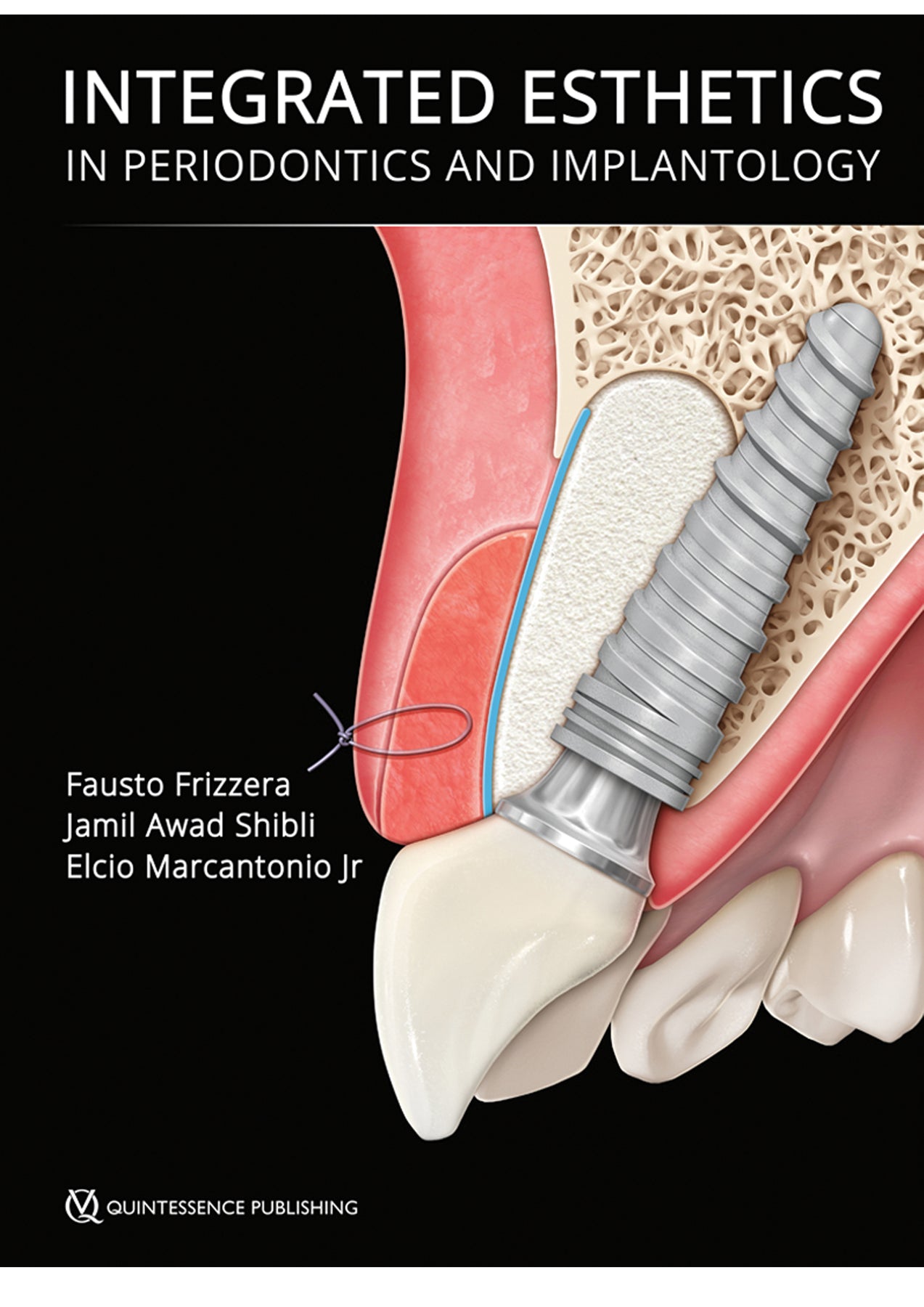 Integrated Esthetics in Periodontics and Implantology – Mi-tec Medical ...