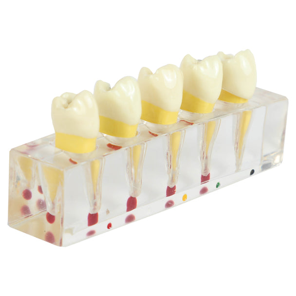 5-stage Endodontic treatment model – Mi-tec Medical Publishing