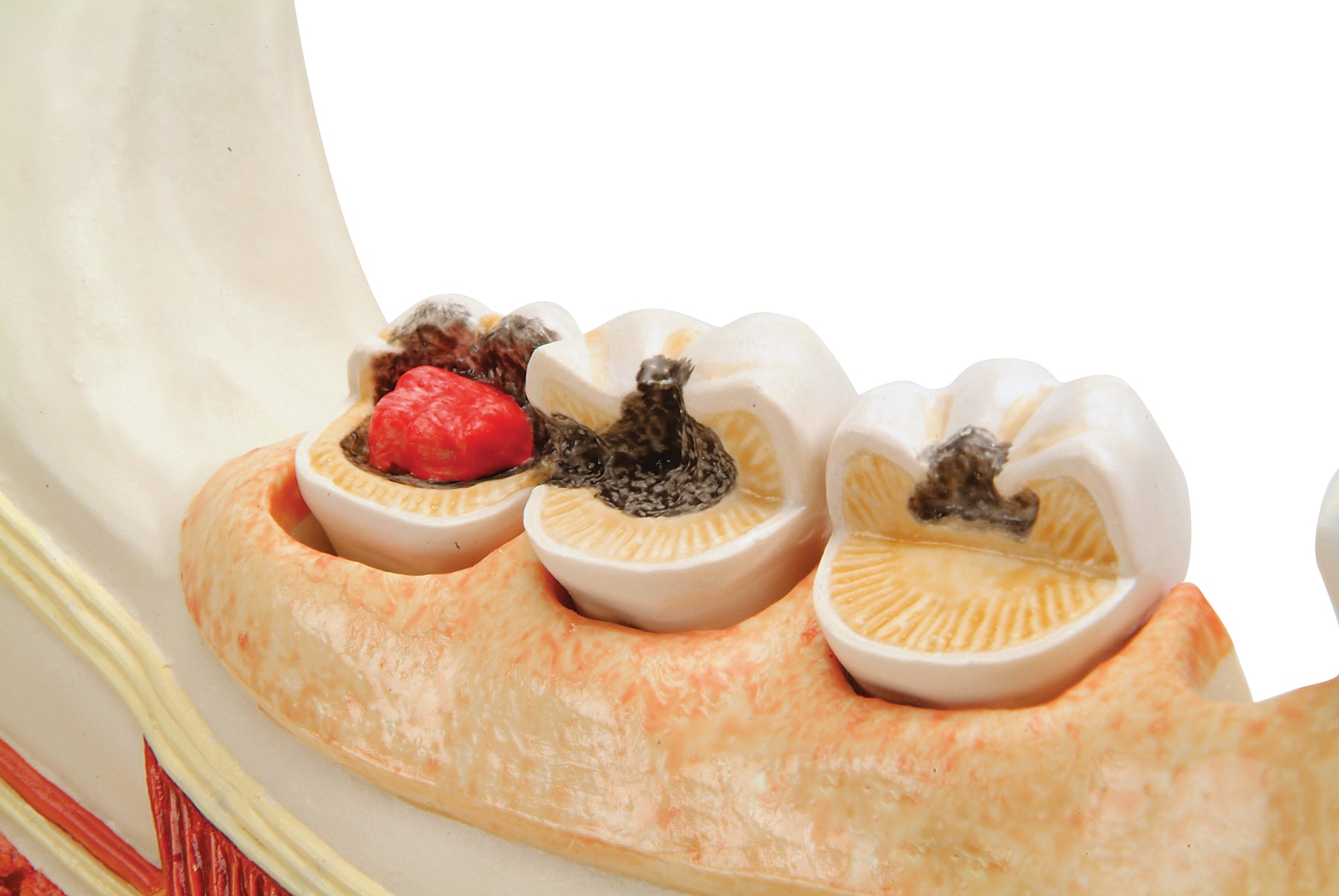 Advanced Half Lower Jaw with 8 diseased teeth, 19 part – Mi-tec Medical ...